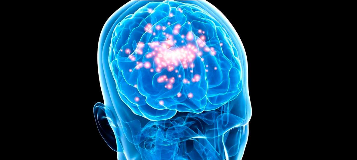 La Epilepsia, signos y síntomas