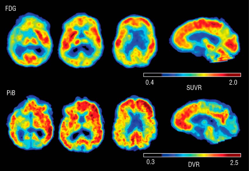 Tomografía PET: uso y definición